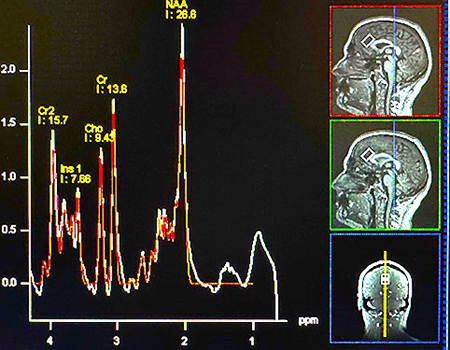 Low choline levels in the brain associated with anxiety disorders ...